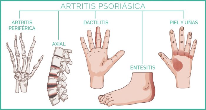 Como Se Diagnostica La Artritis Psoriasica Noticias Médicas
