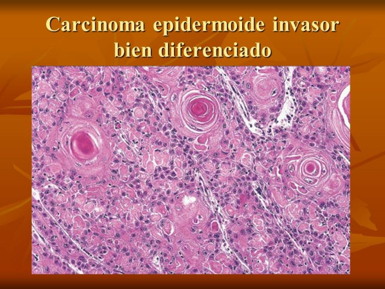 Que quiere decir carcinoma epidermoide - Noticias Médicas